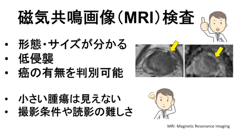 ⑤-4-2-3.S2,3PSA%検査（閾値38％）～PSAの糖鎖変化に注目：2024年に保険収載～