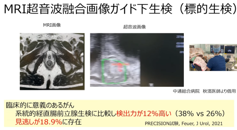 ⑤-4-2-3.S2,3PSA%検査（閾値38％）～PSAの糖鎖変化に注目：2024年に保険収載～